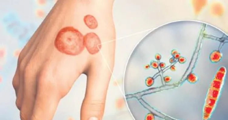 Mantar enfeksiyonları ölüm saçıyor - Yaşam Haberleri