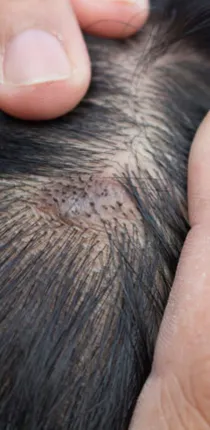 Saç derisindeki sivilcelerin nedenleri - Sağlık Haberleri