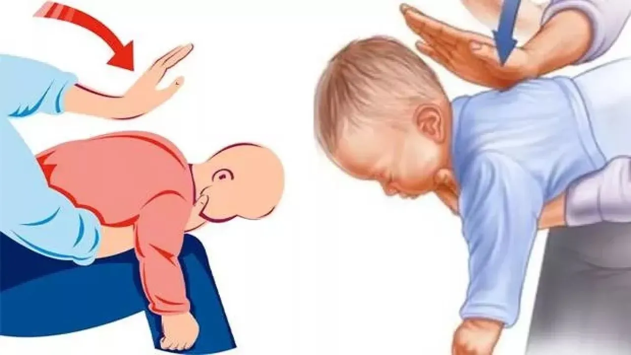 Heimlich manevrası nedir, nasıl uygulanır? Yetişkin ve bebeklerde ... Heimlich manevrası nedir, nasıl uygulanır? Yetişkin ve bebeklerde ...