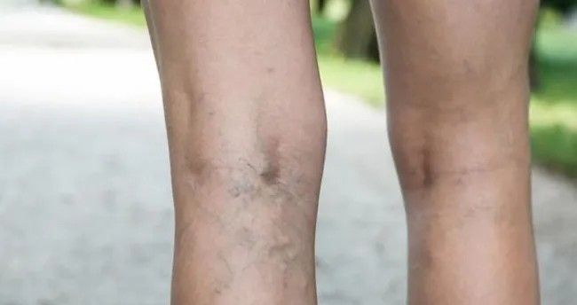 Varis nedir? Varis ne demek? - Sağlık Haberleri