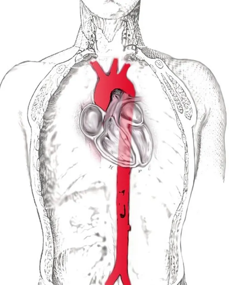 Aort damarı neden yırtılır? - Galeri - Sağlık